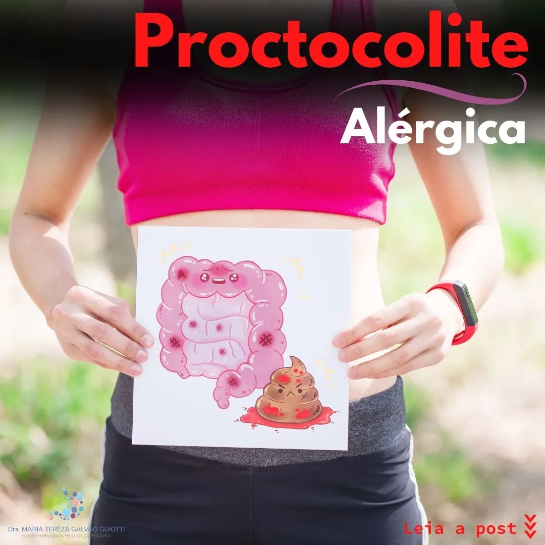 Proctocolite Alérgica - Dra. Maria Tereza Pediatra - Gastroenterologia ...